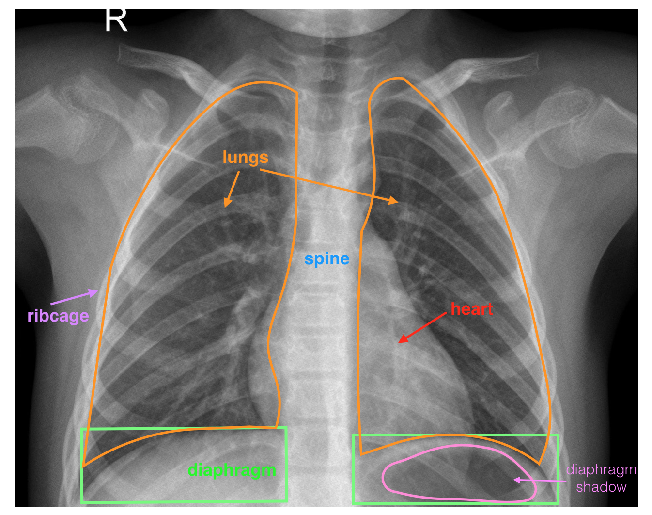 GitHub - rohit077/Pneumonia-Detection-from-Chest-X-Ray-Images-with-Azure
